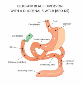 Duodenal Switch Surgery | Lose My Weight and Keep It Off | BMCC